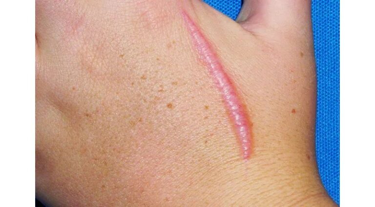 Excessive Scarring has been Linked to Musculoskeletal Disorders ...